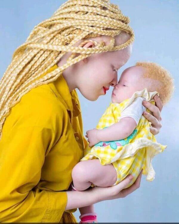 What is Albinism? How Common is it? Who Can Get it? And How? See this ...