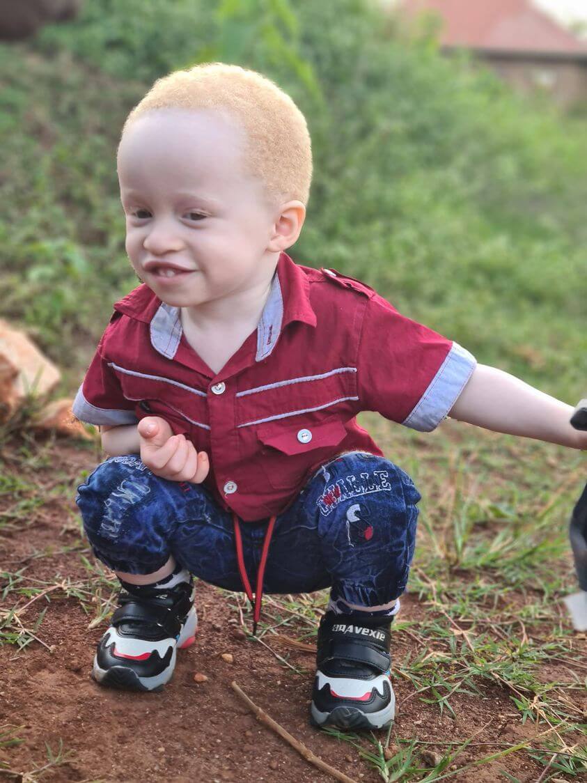 Building Resilient Self-Esteem for Children With Albinism: A Parent's ...
